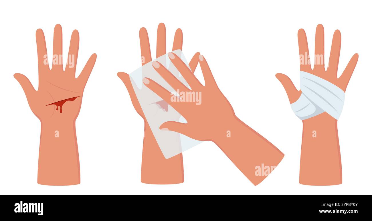 Bleeding cut on the palm, emergency situation. First aid treatment for ...