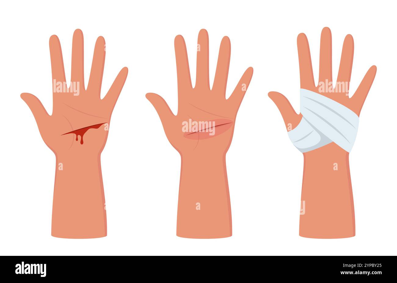 Bleeding cut on the palm, emergency situation. First aid treatment for ...