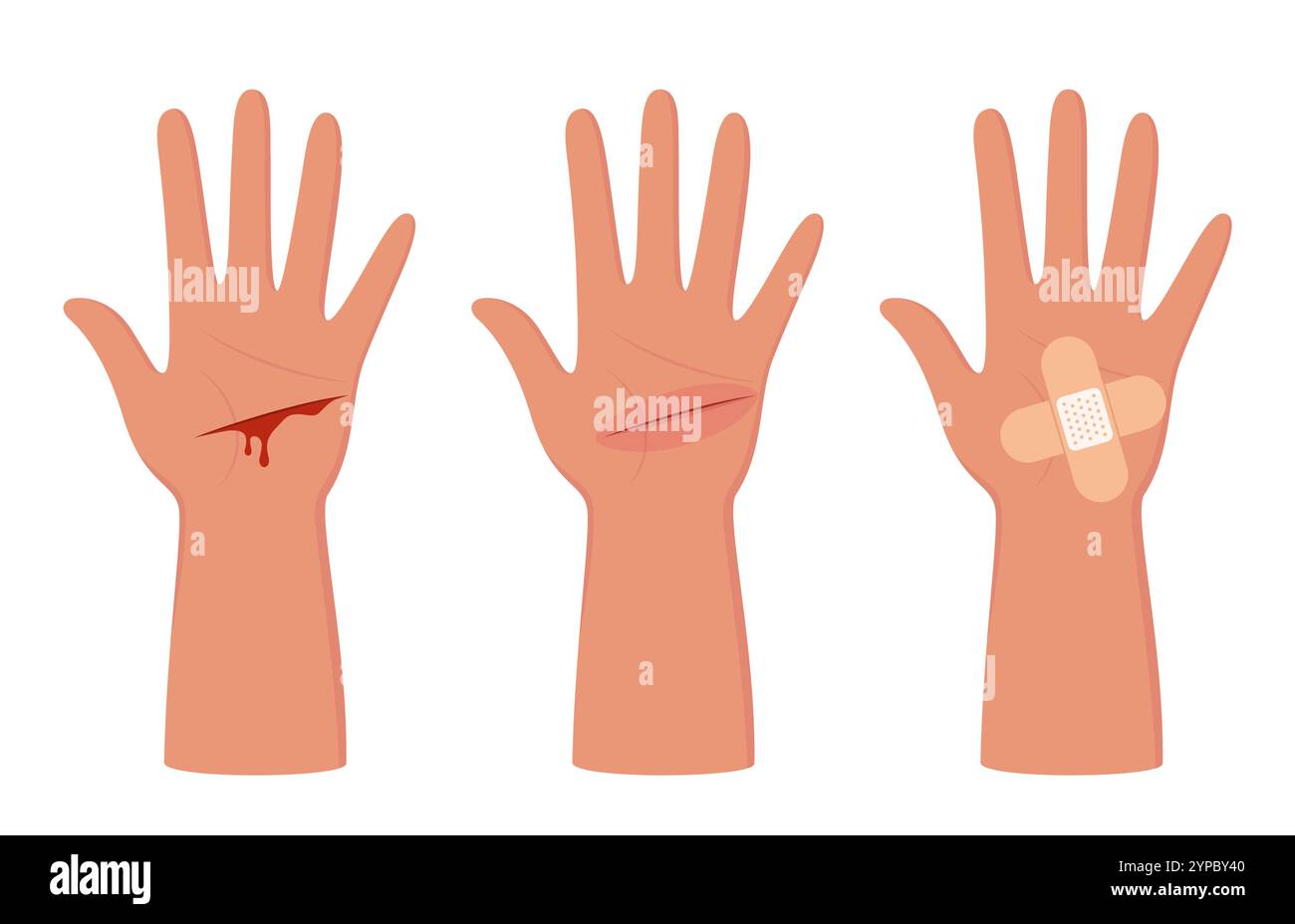 Bleeding cut on the palm, emergency situation. First aid treatment for ...