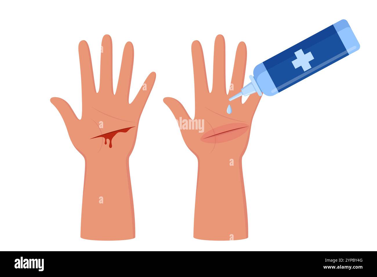 Bleeding cut on the palm, emergency situation. First aid treatment for ...