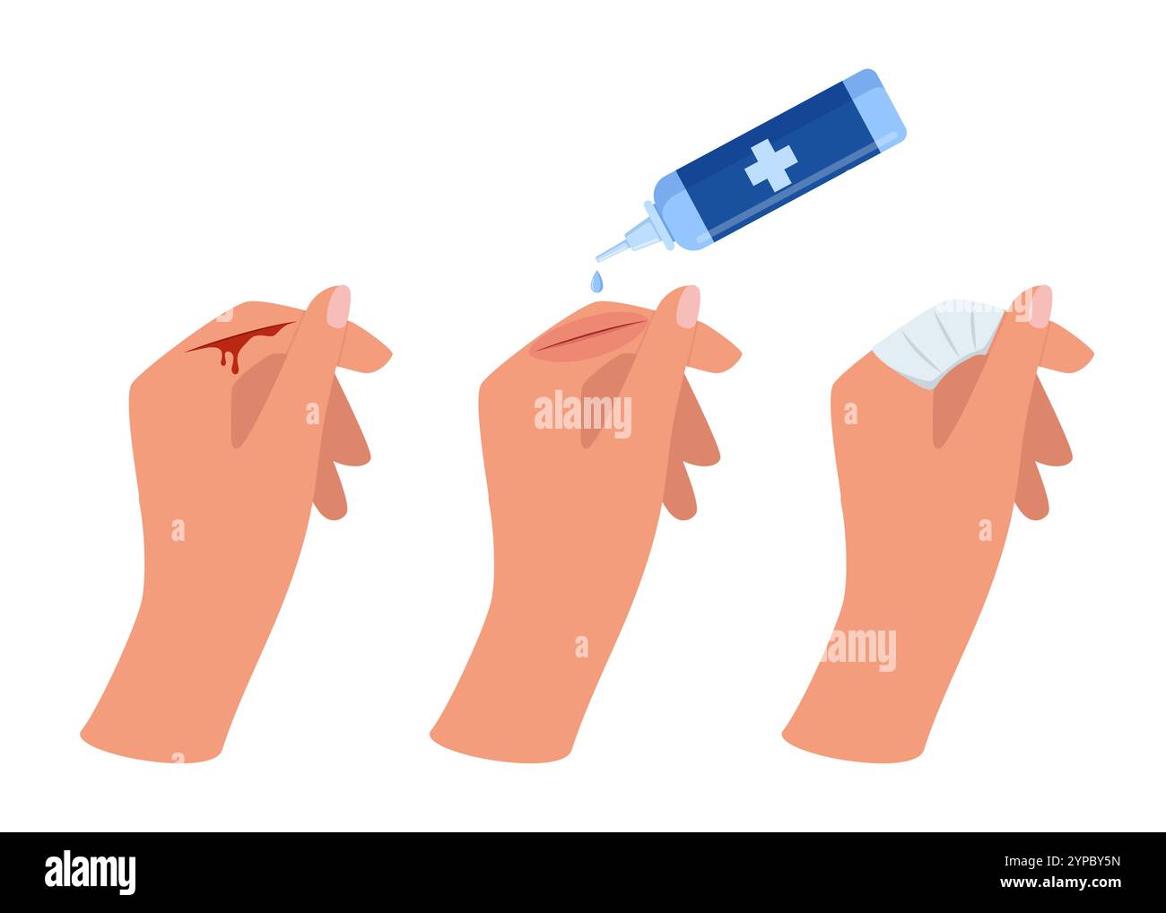 Bleeding cut on the palm, emergency situation. First aid treatment for wound on skin. Trauma ...