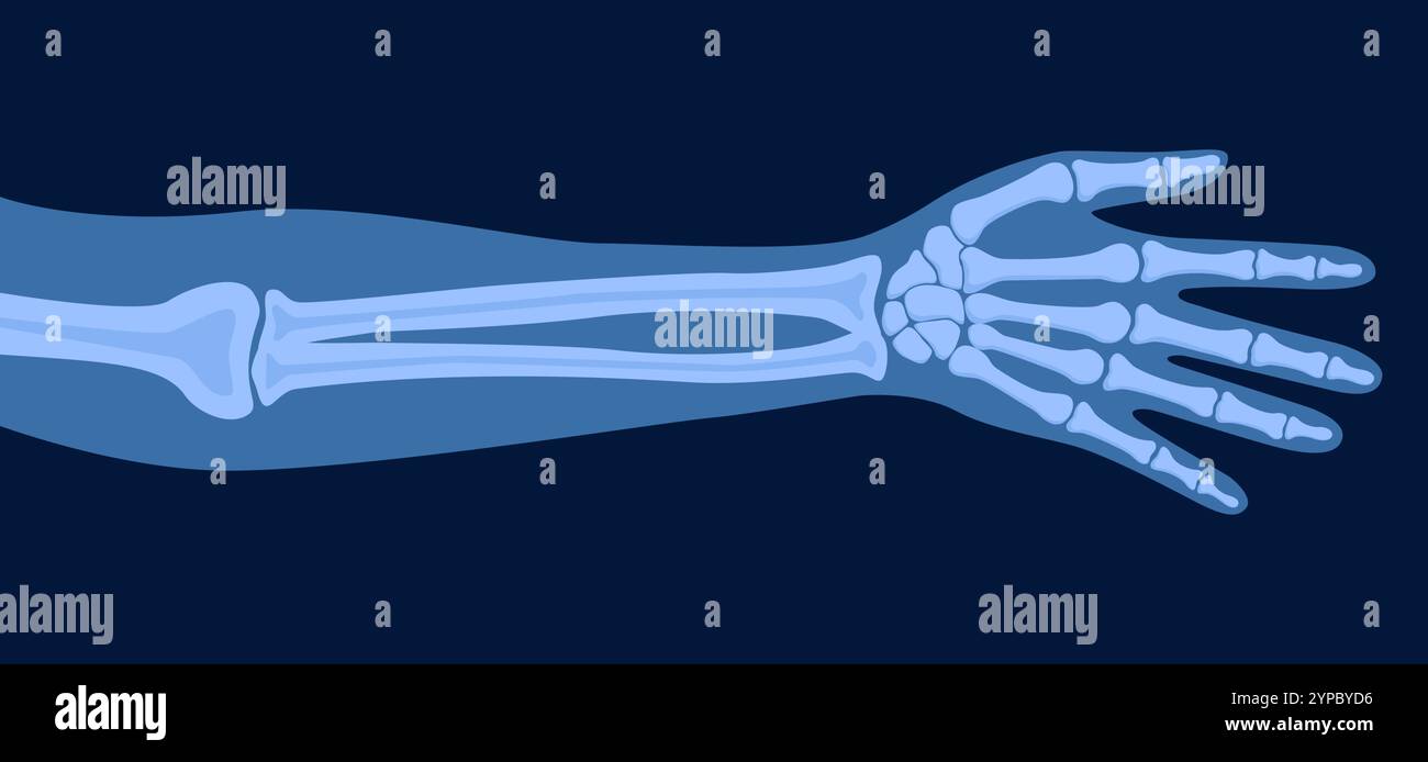X ray human hand. Body bone roentgen front view. Medical anatomy. Arm ...