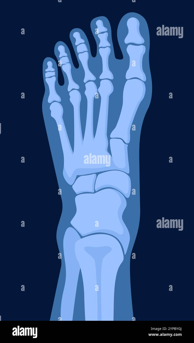 X ray human foot. X-ray picture or radiographic monitor image of ...