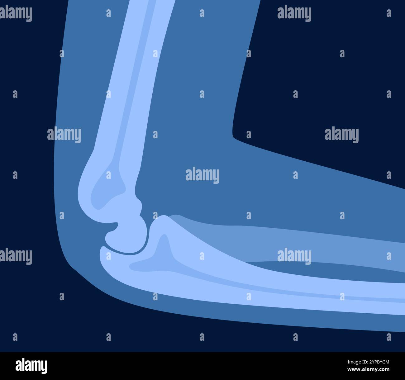 Shoulder in pain x ray Stock Vector Images - Alamy