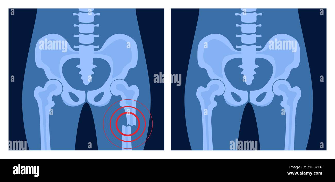 X ray of femur fracture with red pain point. Broken leg with open type ...