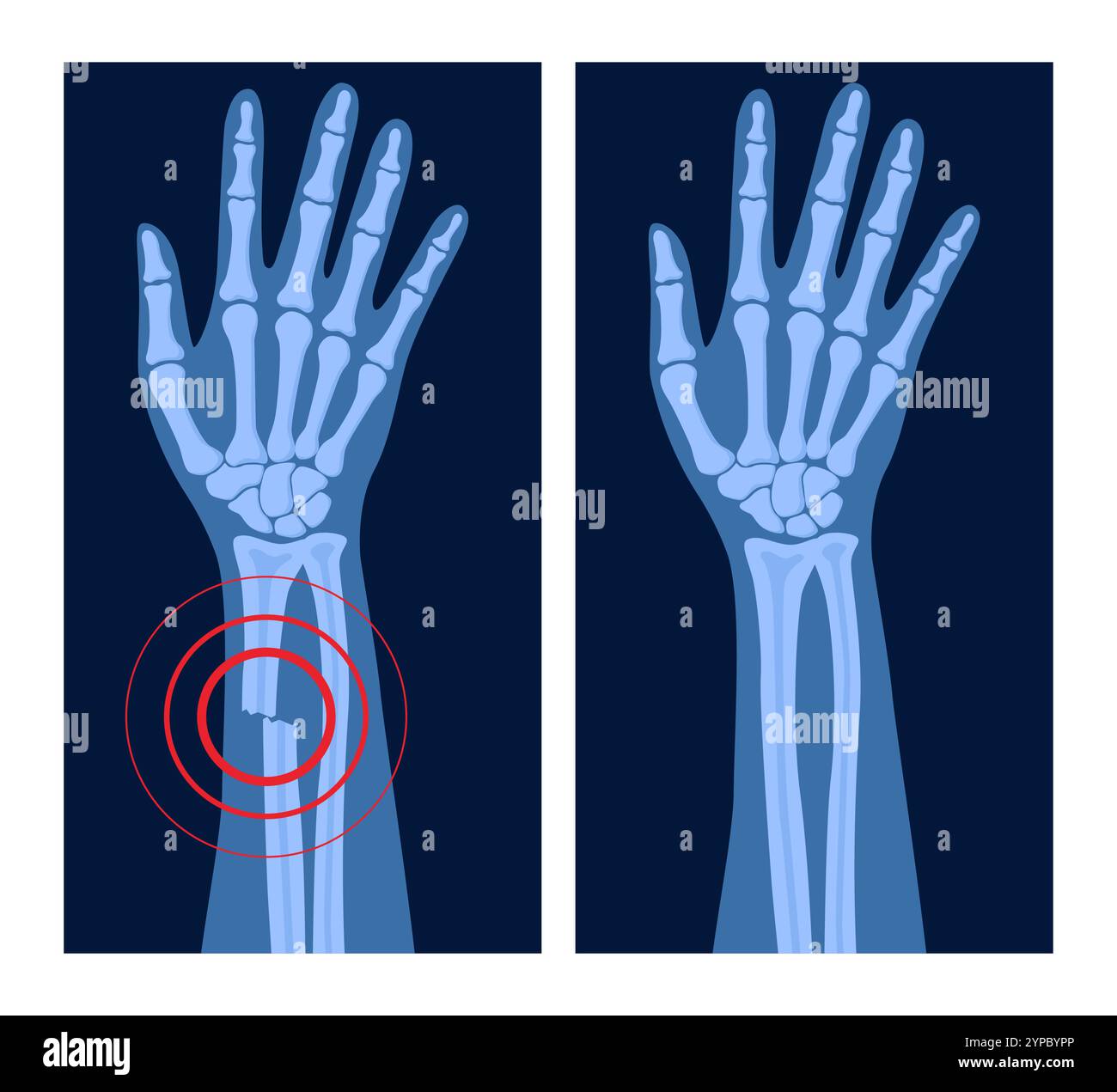 X ray of arm fracture with red pain point. Broken hand with open type ...