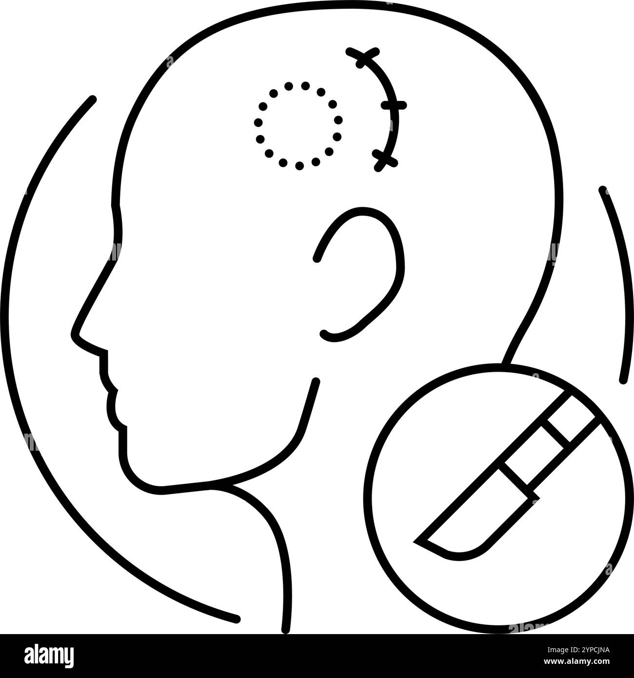 Craniotomy Stock Vector Images - Alamy