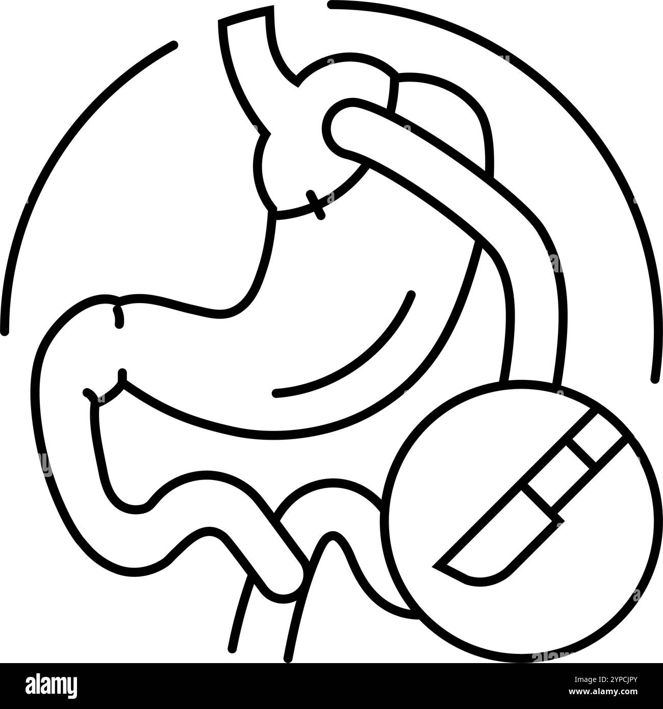Gastric bypass surgery Stock Vector Images - Alamy