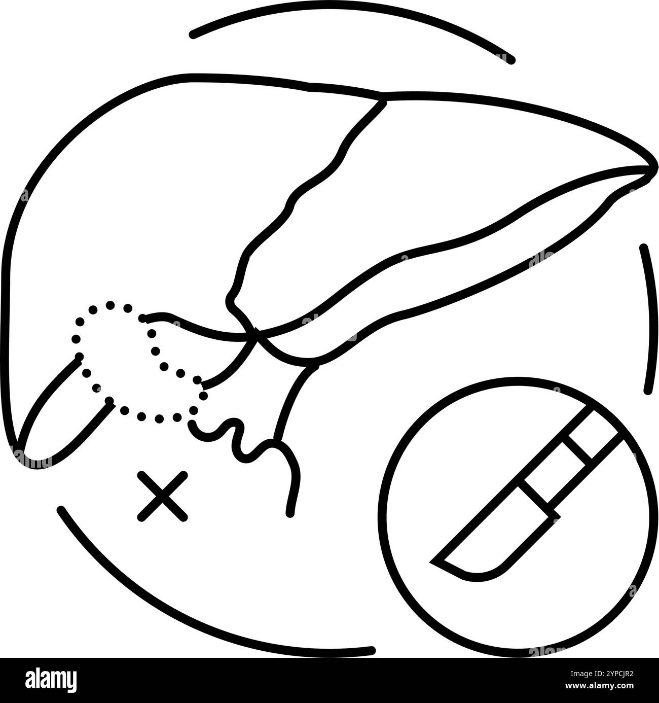 cholecystectomy surgery line icon vector illustration Stock Vector ...