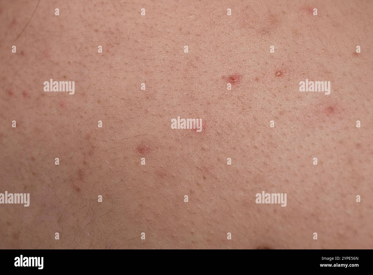 Skin texture background. Acne pimple. Treatment for skin. Problem ...