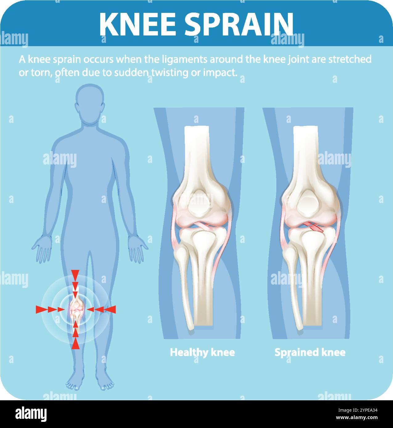 Illustration of healthy and sprained knee joints Stock Vector Image ...