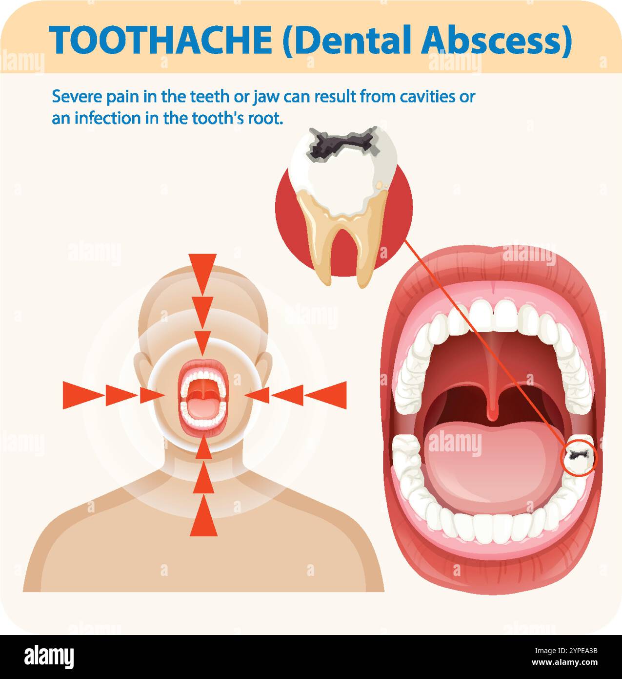 Hygiene tooth toothache x ray Cut Out Stock Images & Pictures - Alamy