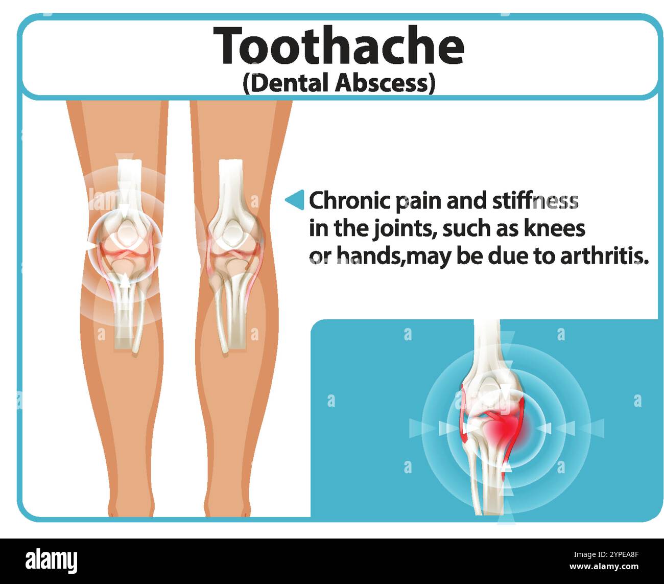 Illustration of knee joints with arthritis symptoms Stock Vector Image ...