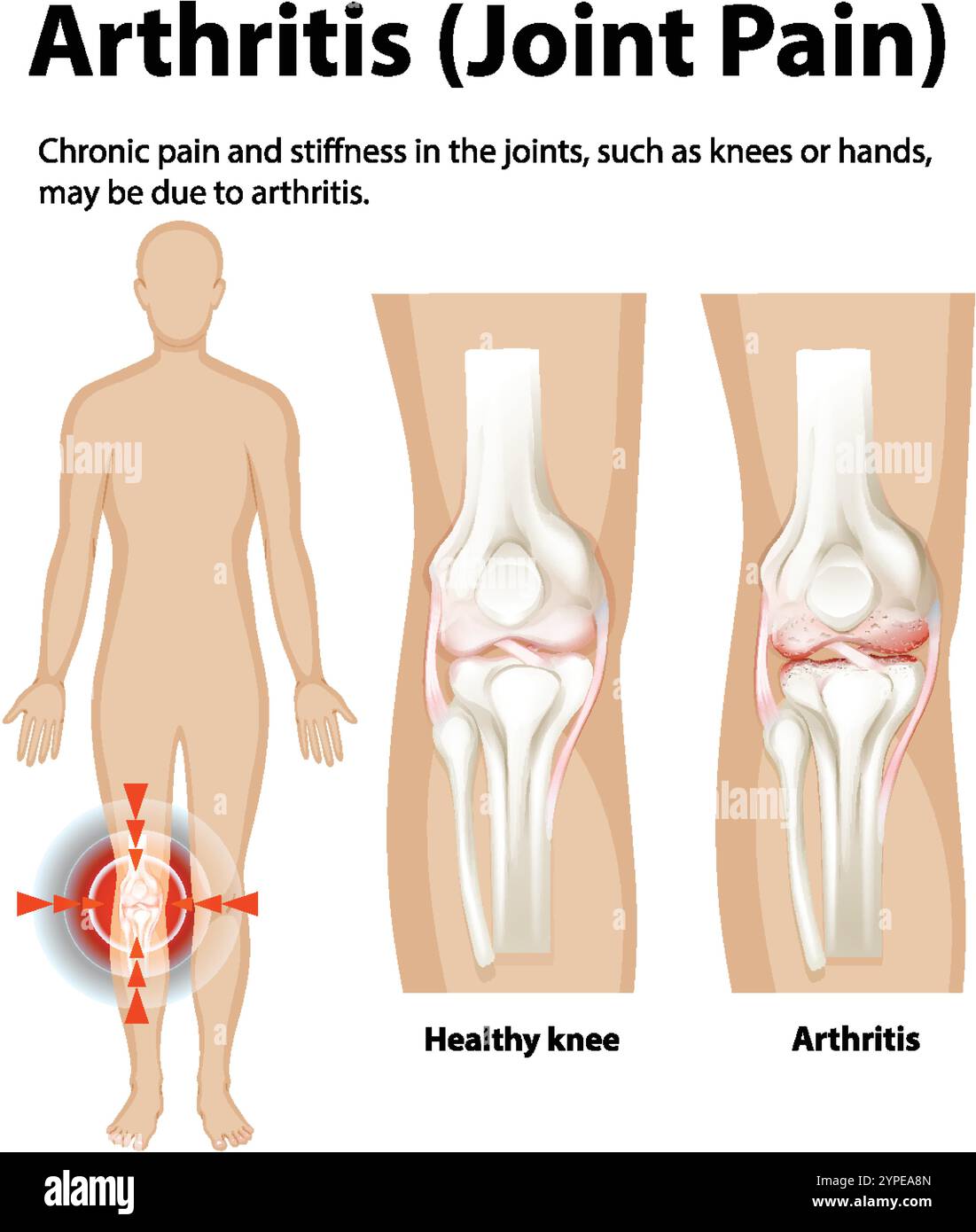 Knee injury prevention Stock Vector Images - Alamy