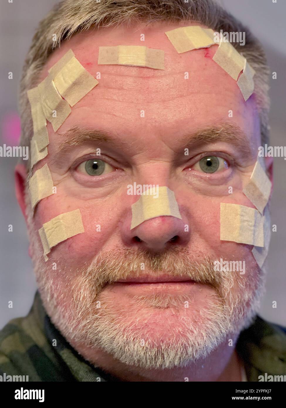 Man with many small wound patches on his face, after a laser treatment ...