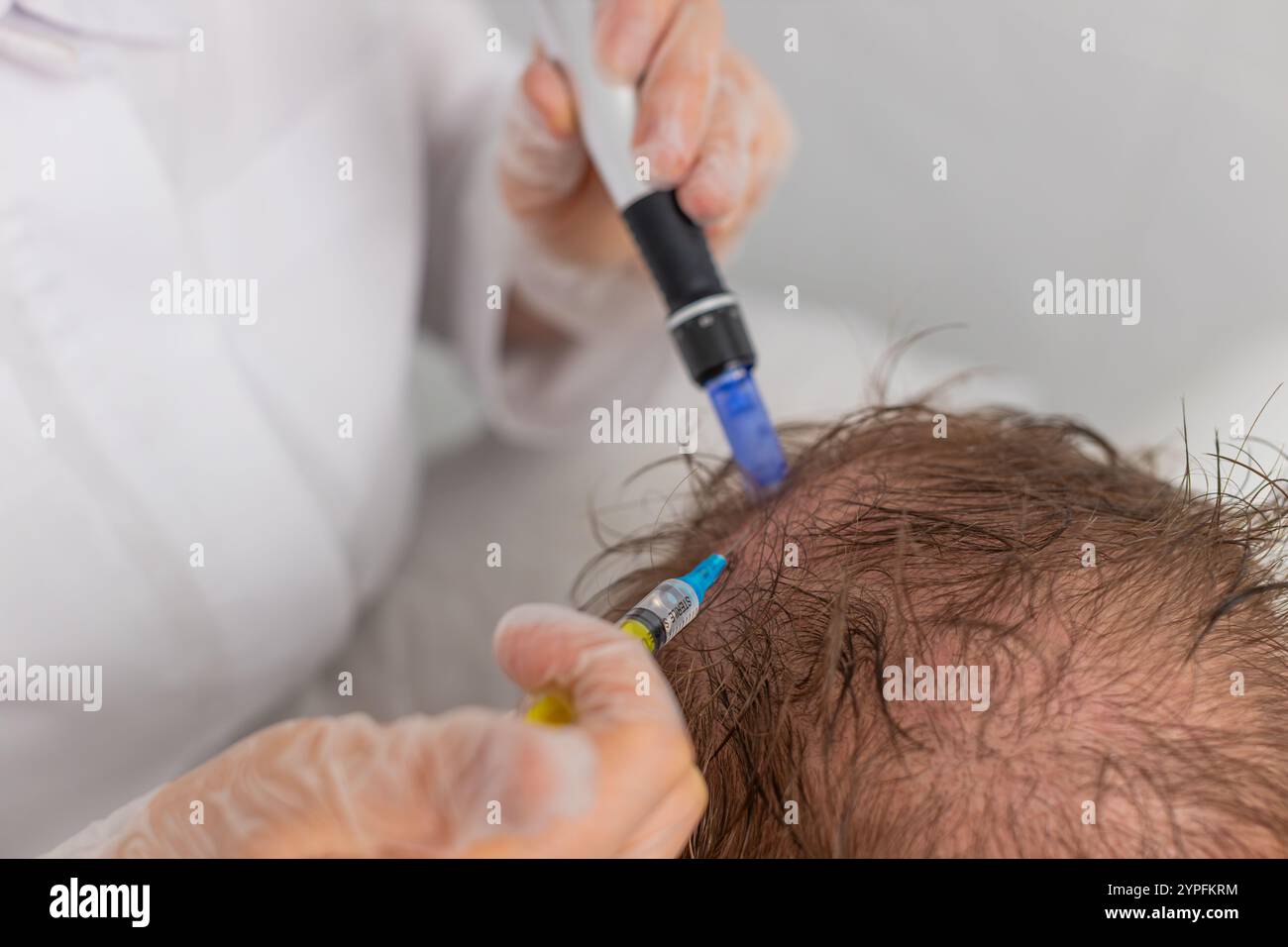 Alopecia. Man hair loss improve growth treatment regeneration, dermapen ...