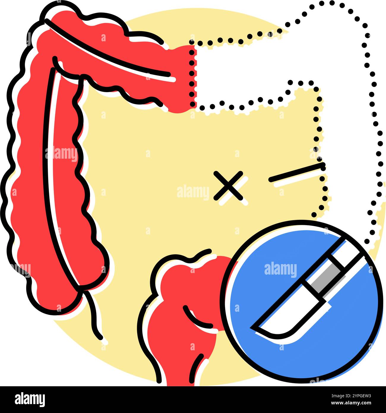 bowel resection surgery doctor color icon vector illustration Stock ...
