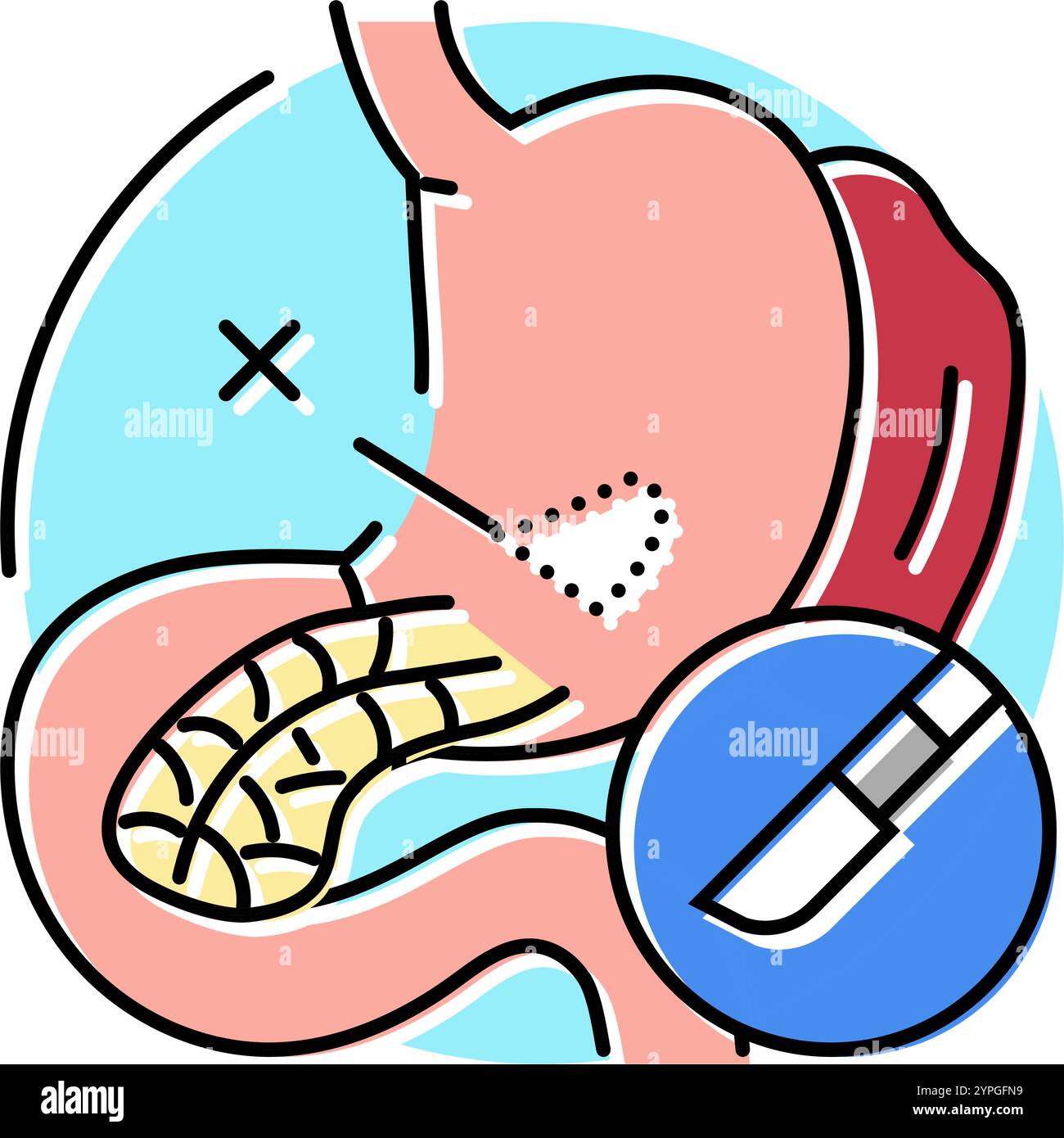 pancreatectomy surgery hospital color icon vector illustration Stock ...