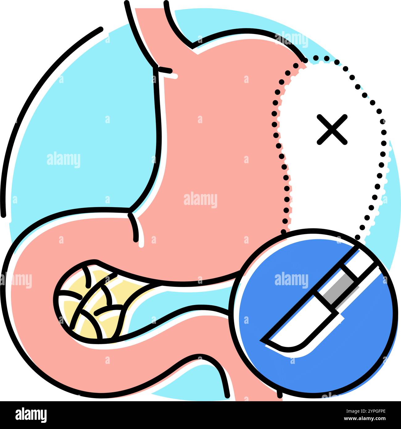 splenectomy surgery hospital color icon vector illustration Stock ...