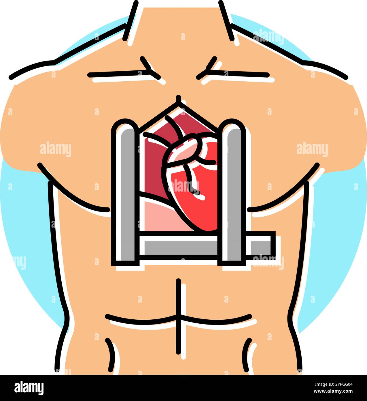 Stent Cartoon