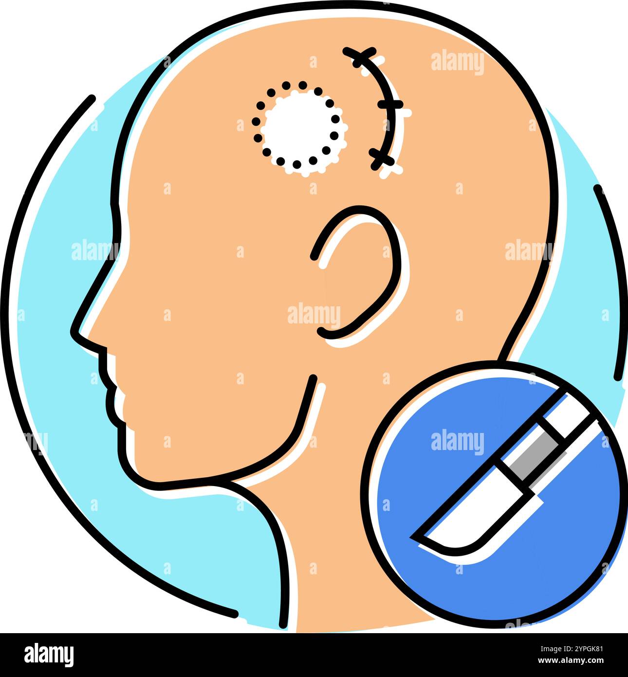 Craniotomy Stock Vector Images - Alamy