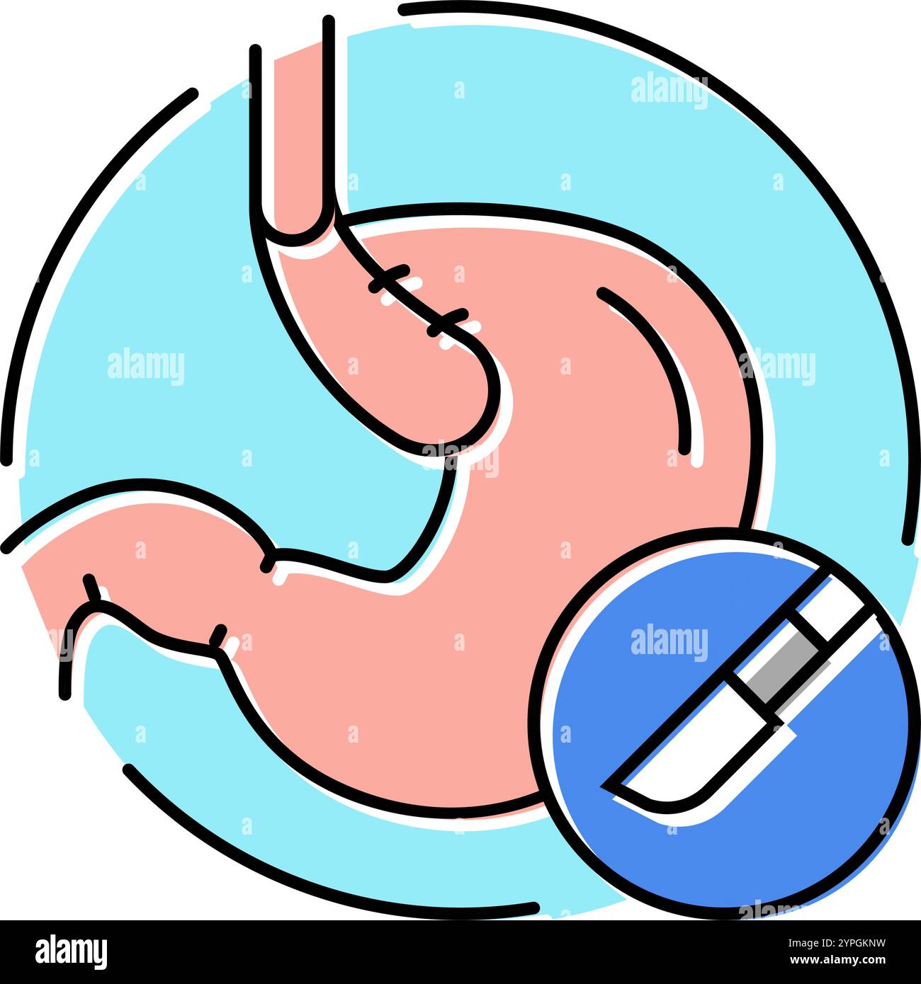Fundoplication hi-res stock photography and images - Alamy