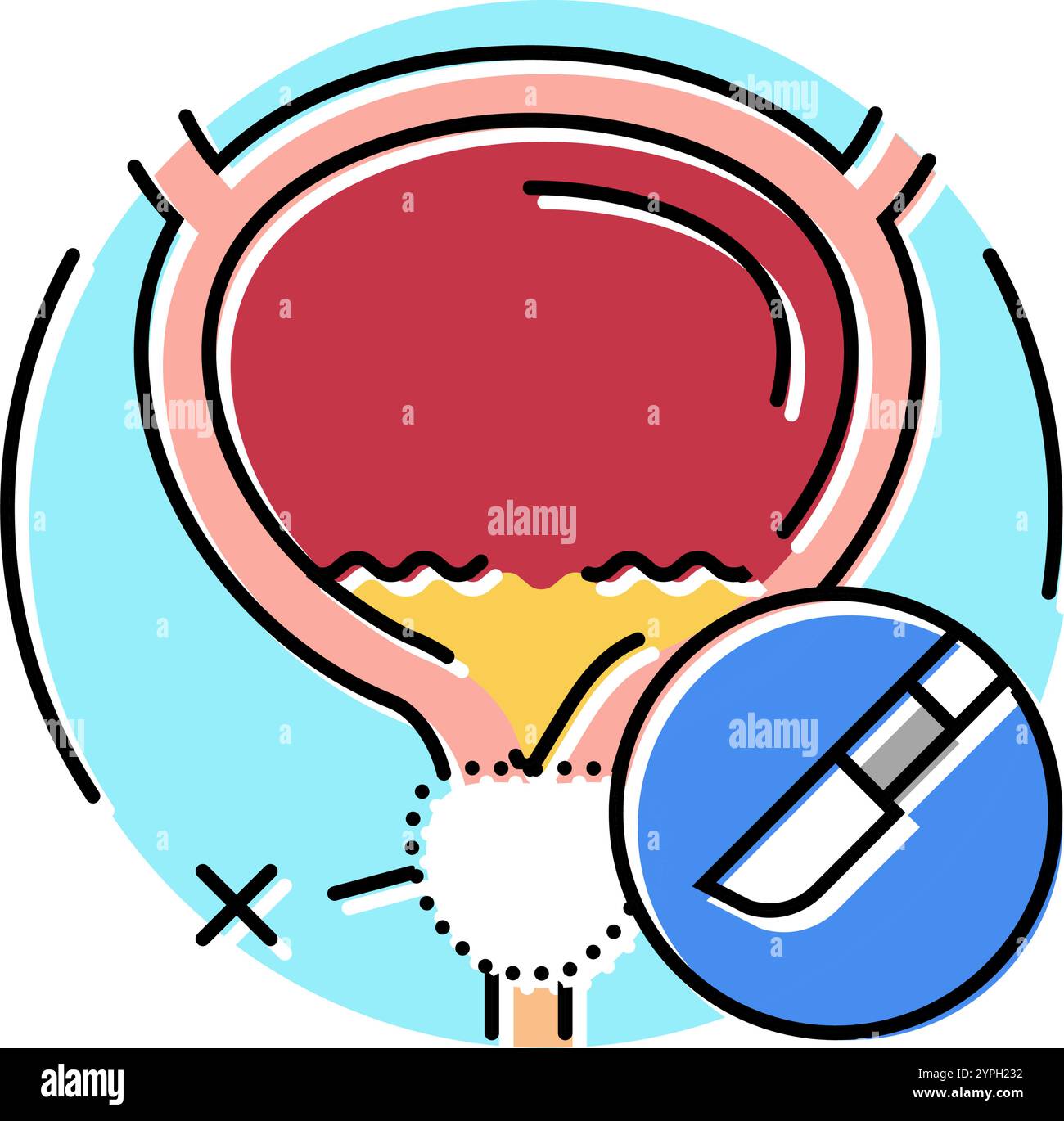 Prostatectomy Stock Vector Images - Alamy