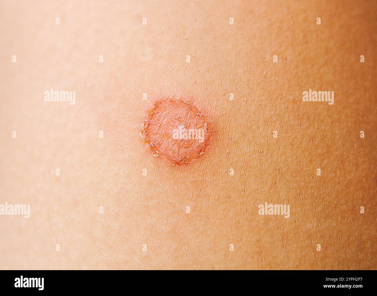 Sandfly bite hi-res stock photography and images - Alamy