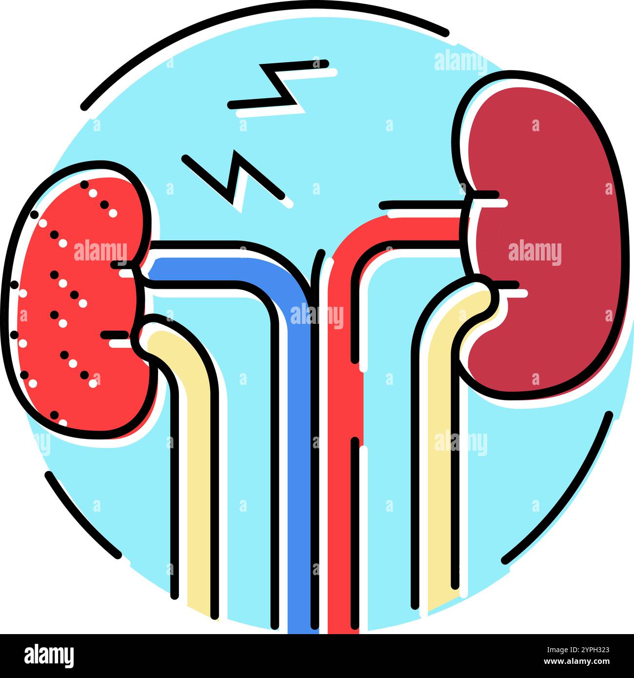 Nephrectomy hi-res stock photography and images - Alamy