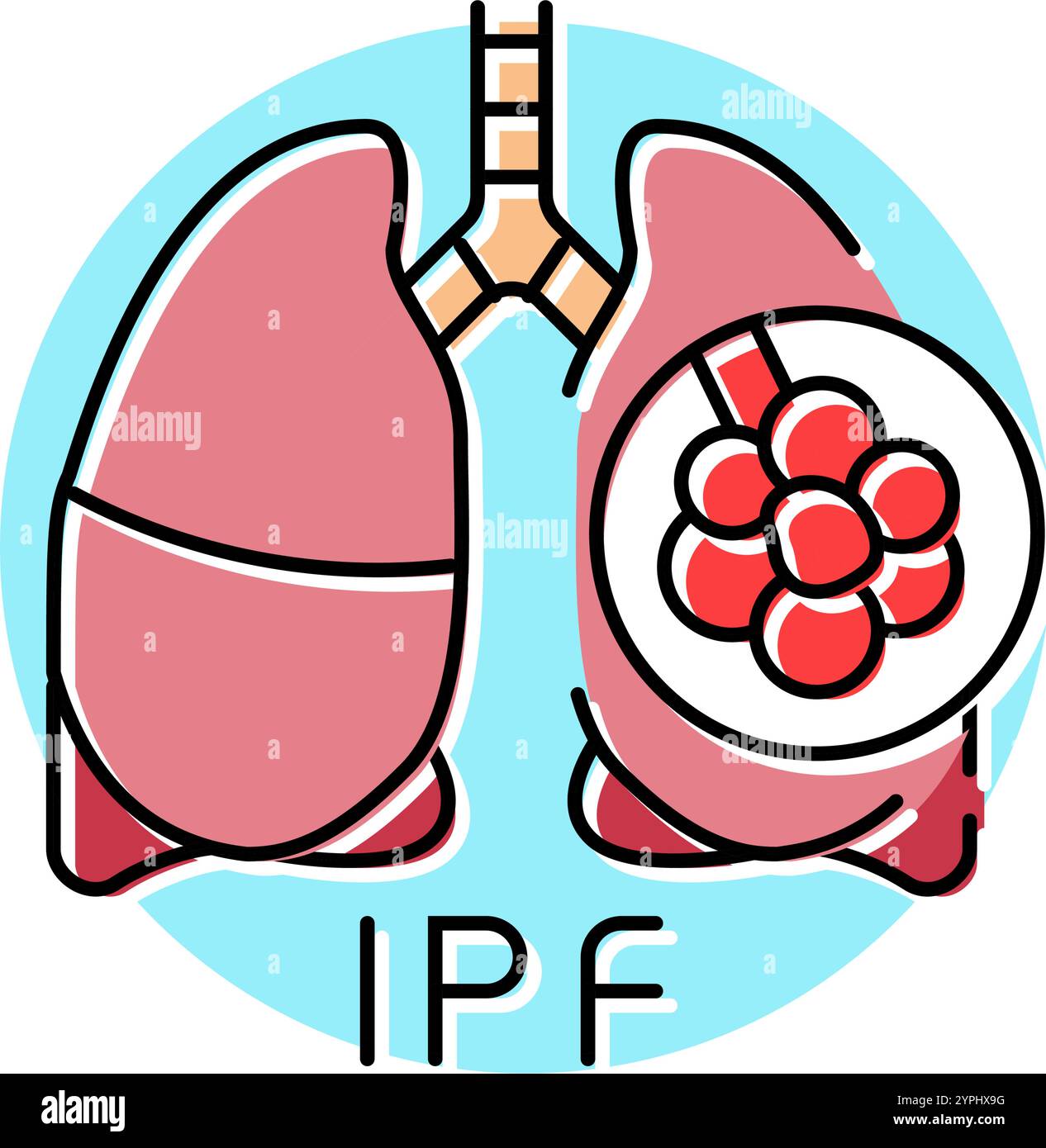 idiopathic pulmonary fibrosis color icon vector illustration Stock ...