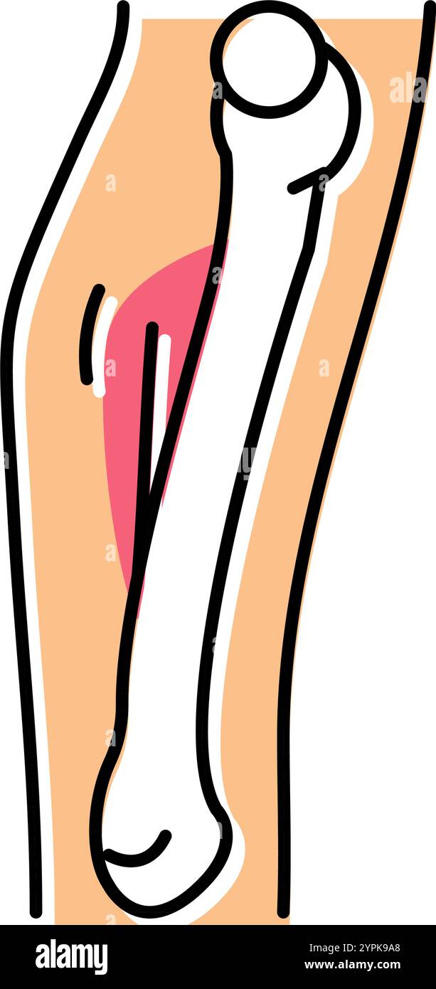 Stress fracture x ray hi-res stock photography and images - Alamy