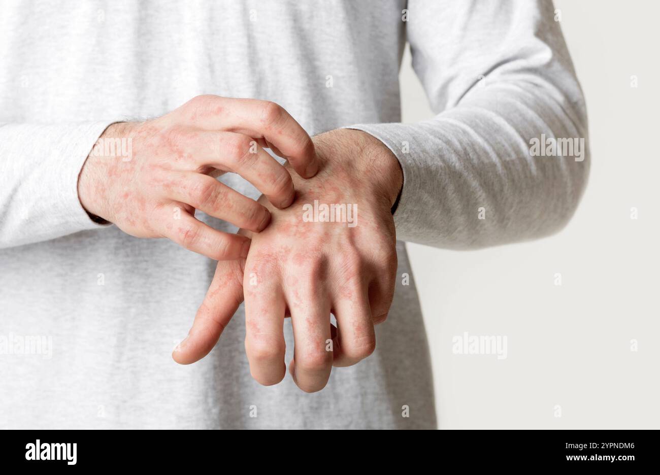 Red spots on hands. Man itches, close up Stock Photo - Alamy