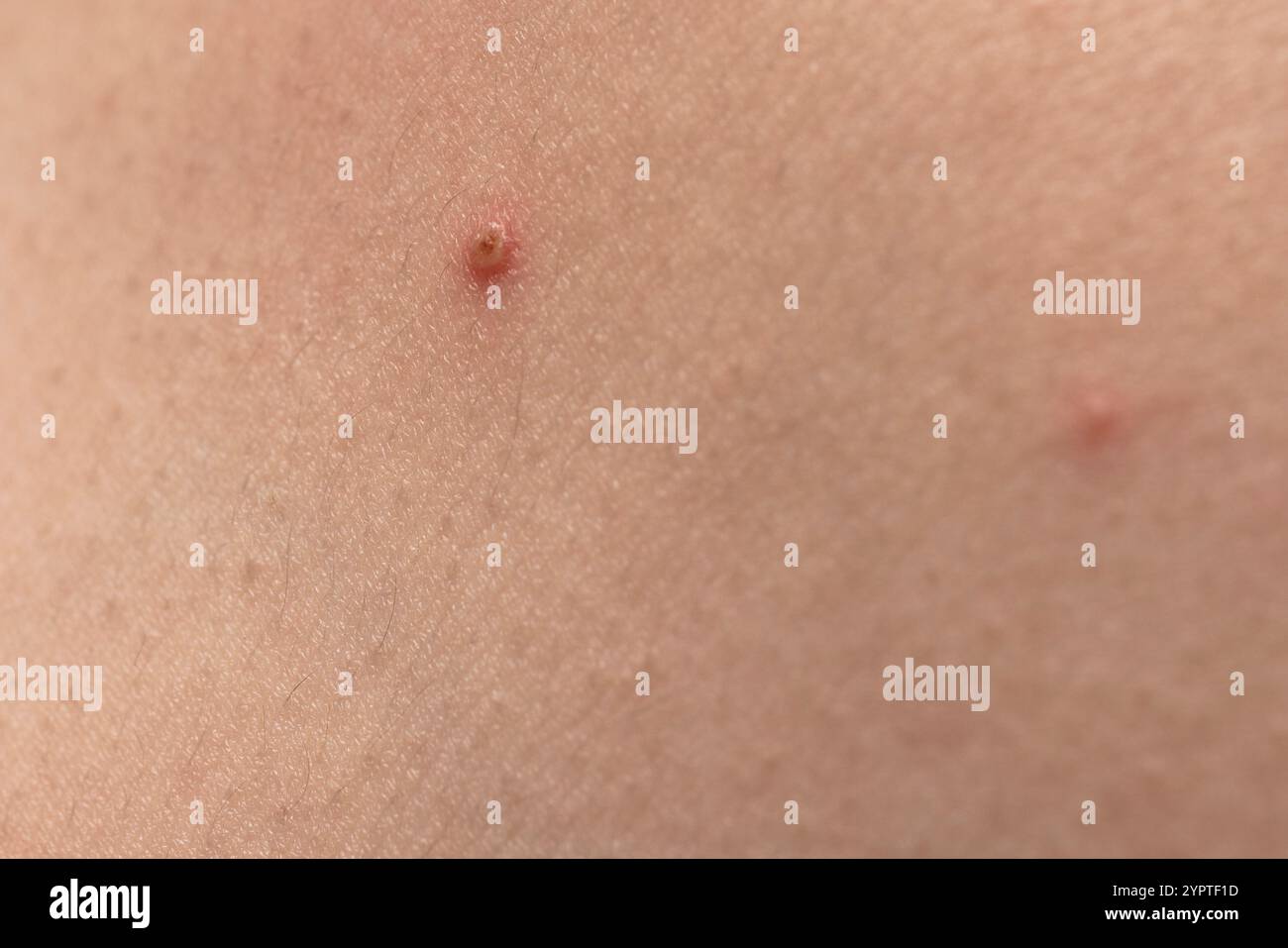 Pimple closeup. Skin texture. Closeup acne skin. Treatment for skin ...