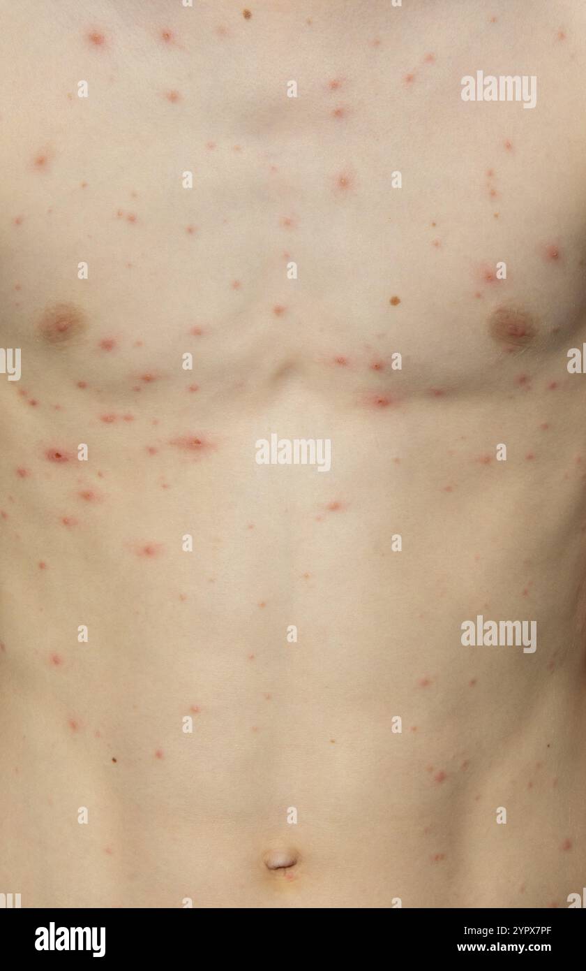Chickenpox rash on a body of a young boy. Chickenpox is a contagious ...