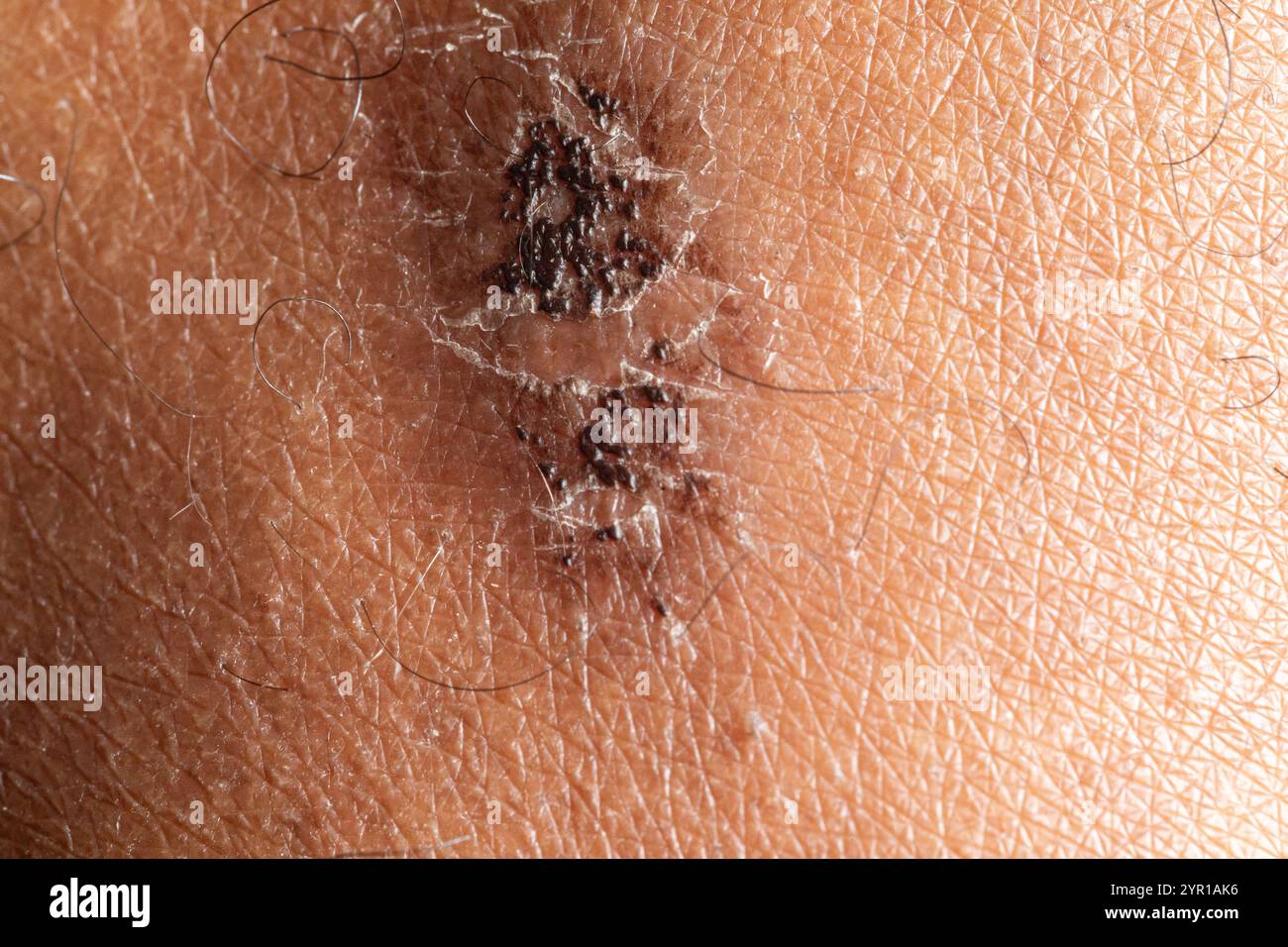 Scab scar hi-res stock photography and images - Alamy