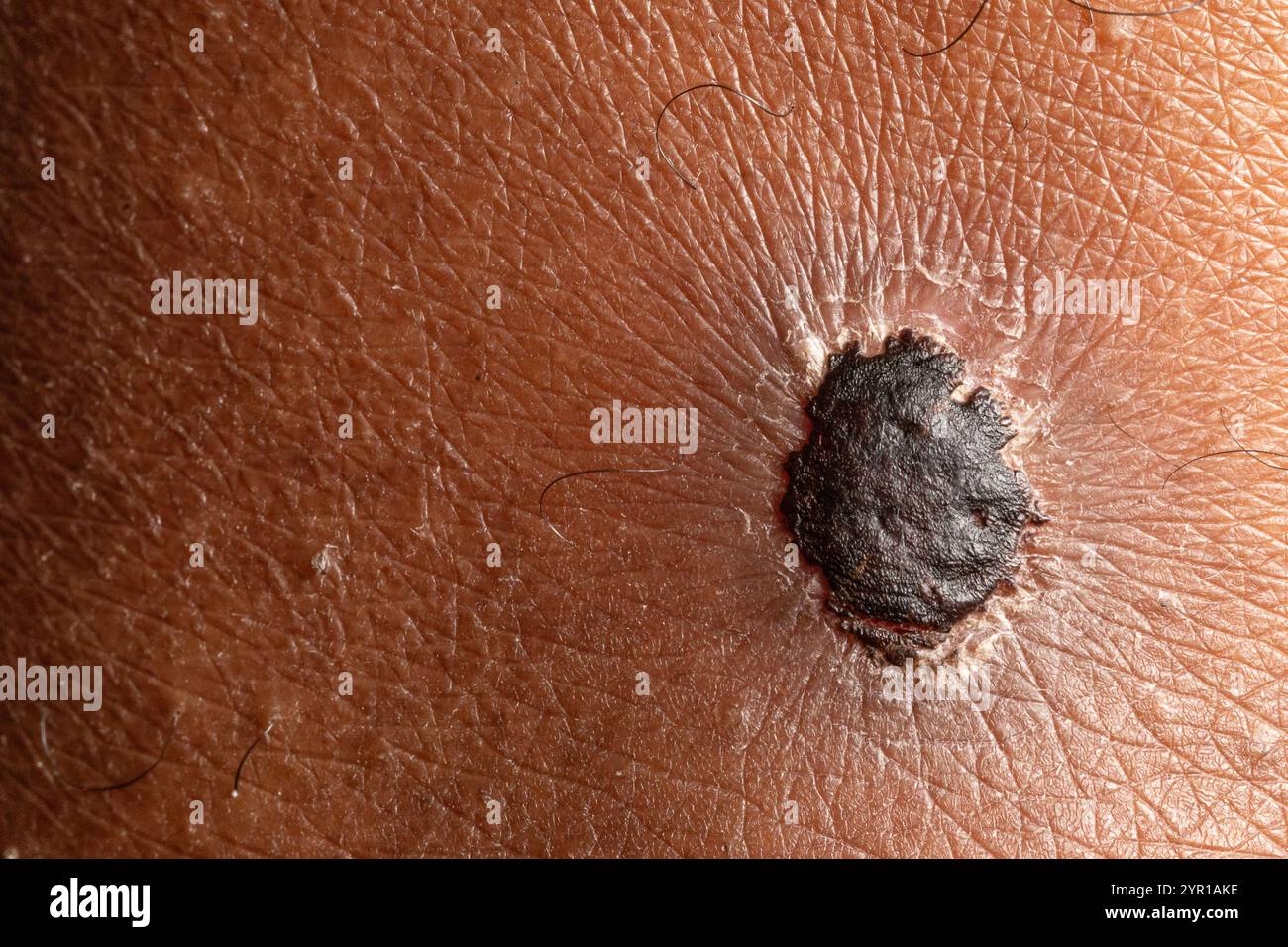 Skin cancer hi-res stock photography and images - Alamy