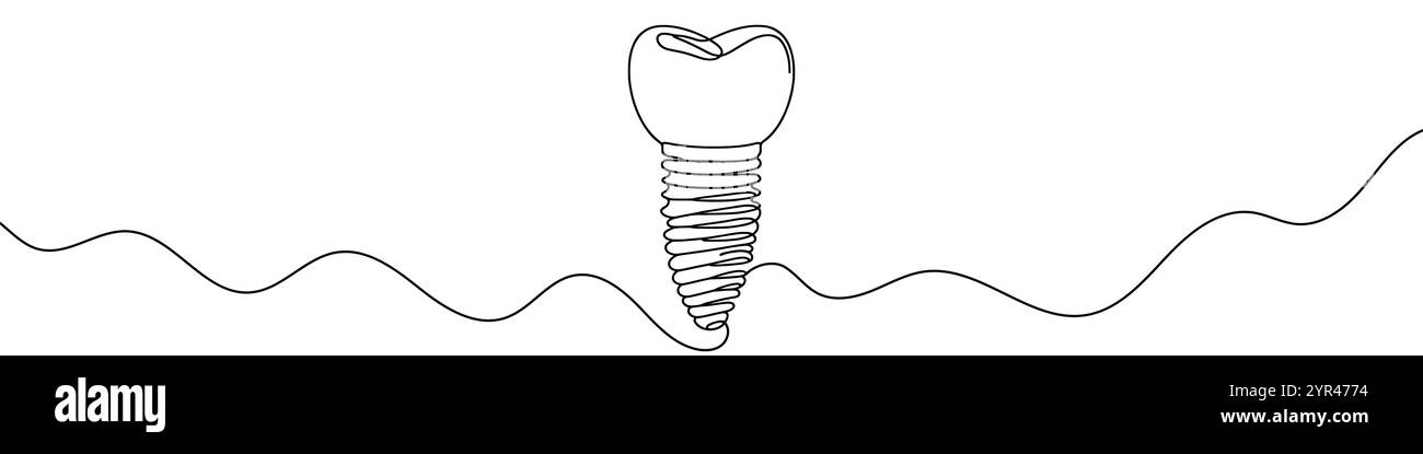 One continuous line illustration of dental implant, isolated on white ...