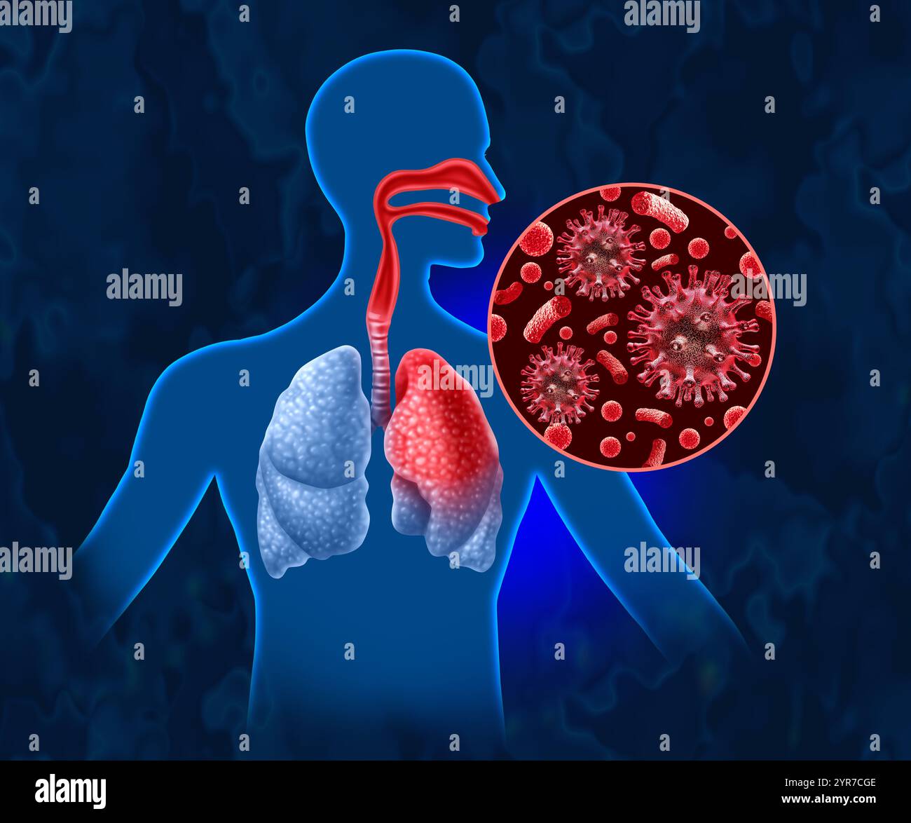 Acute Respiratory Disease or ARD affecting different parts of the ...
