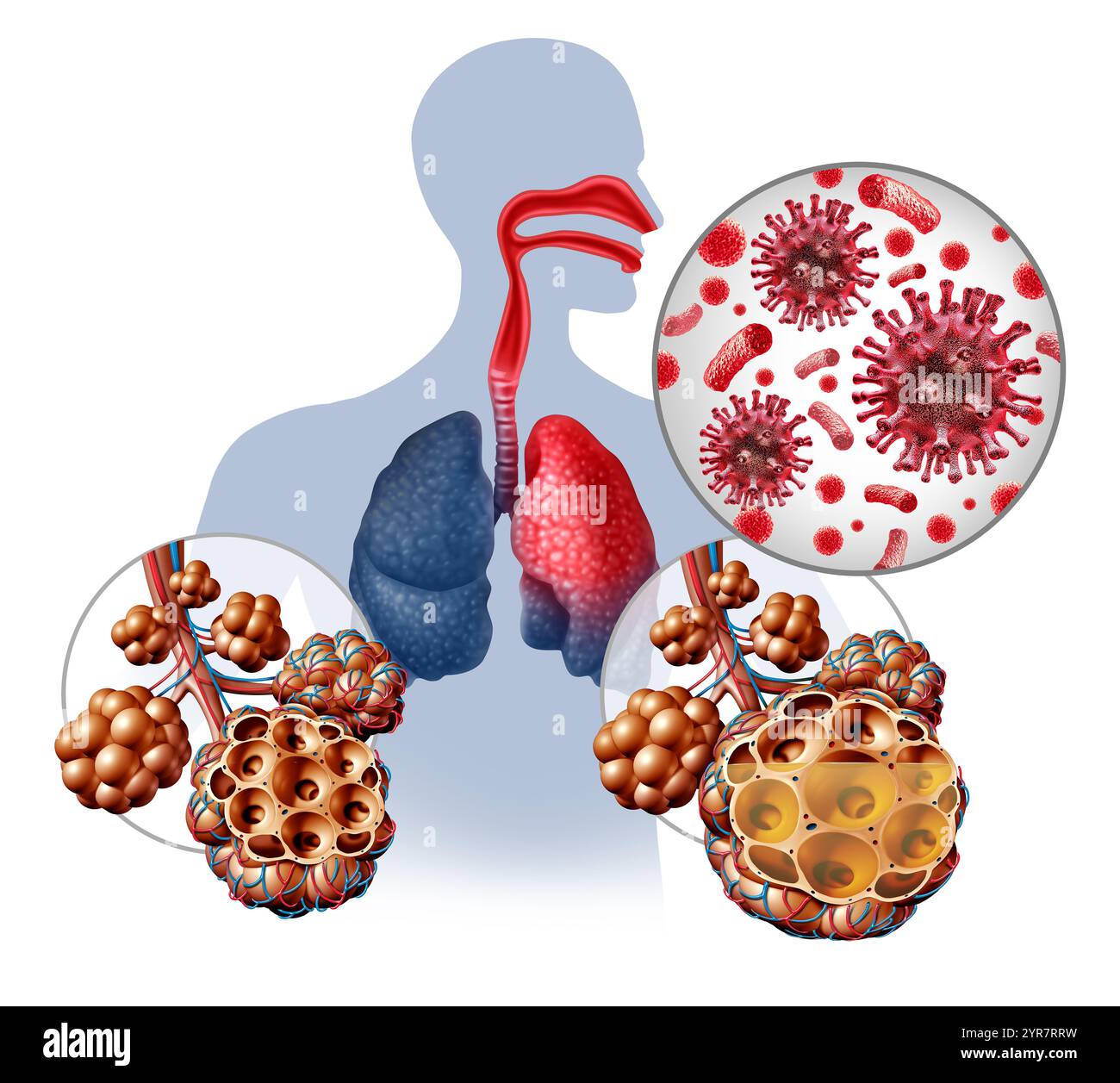 Acute Respiratory Disease or ARD affecting different parts of the ...