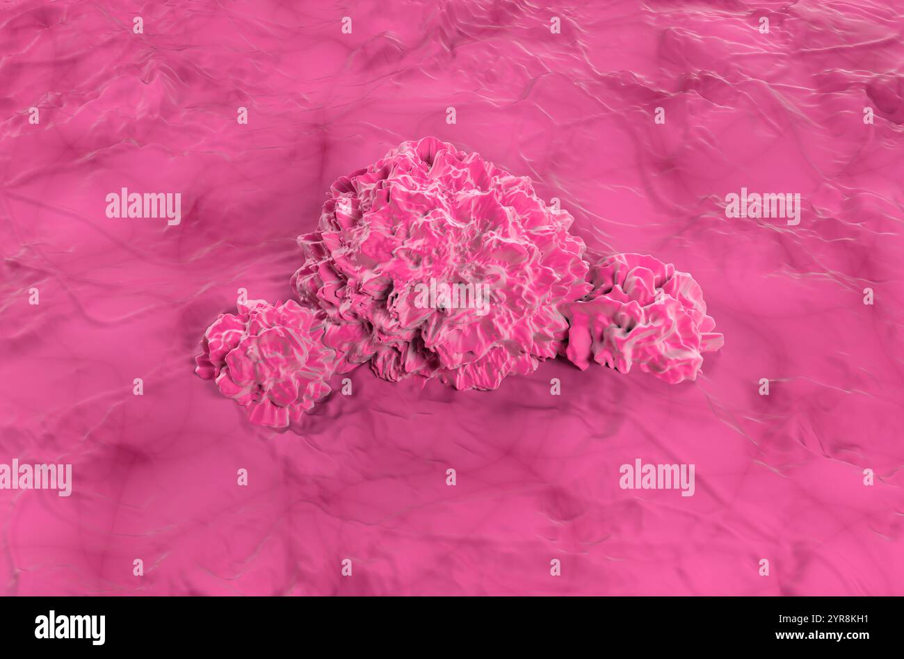 Bladder cancer - isometric view 3d illustration Stock Photo - Alamy