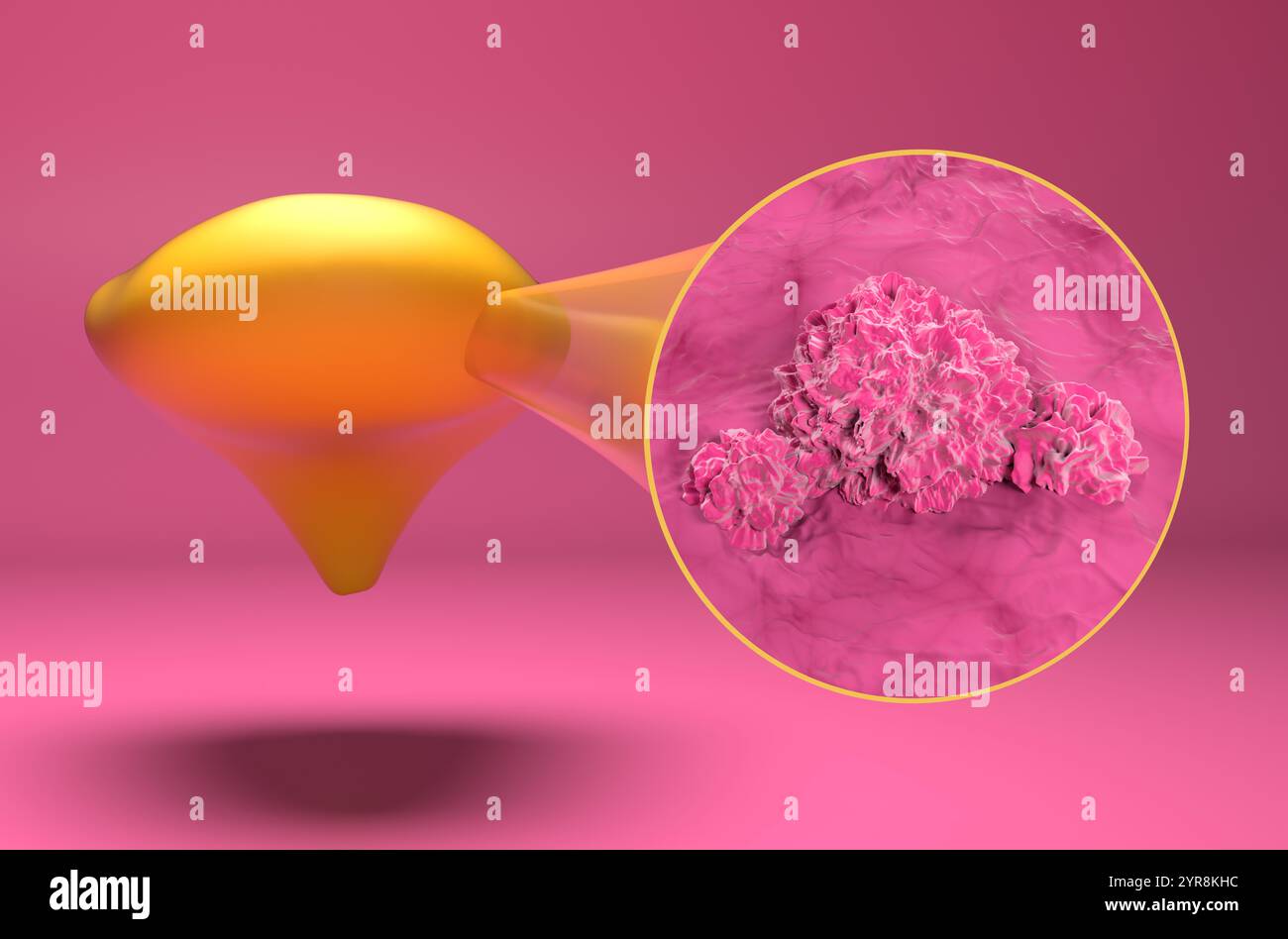 Bladder cancer - isometric view 3d illustration Stock Photo - Alamy