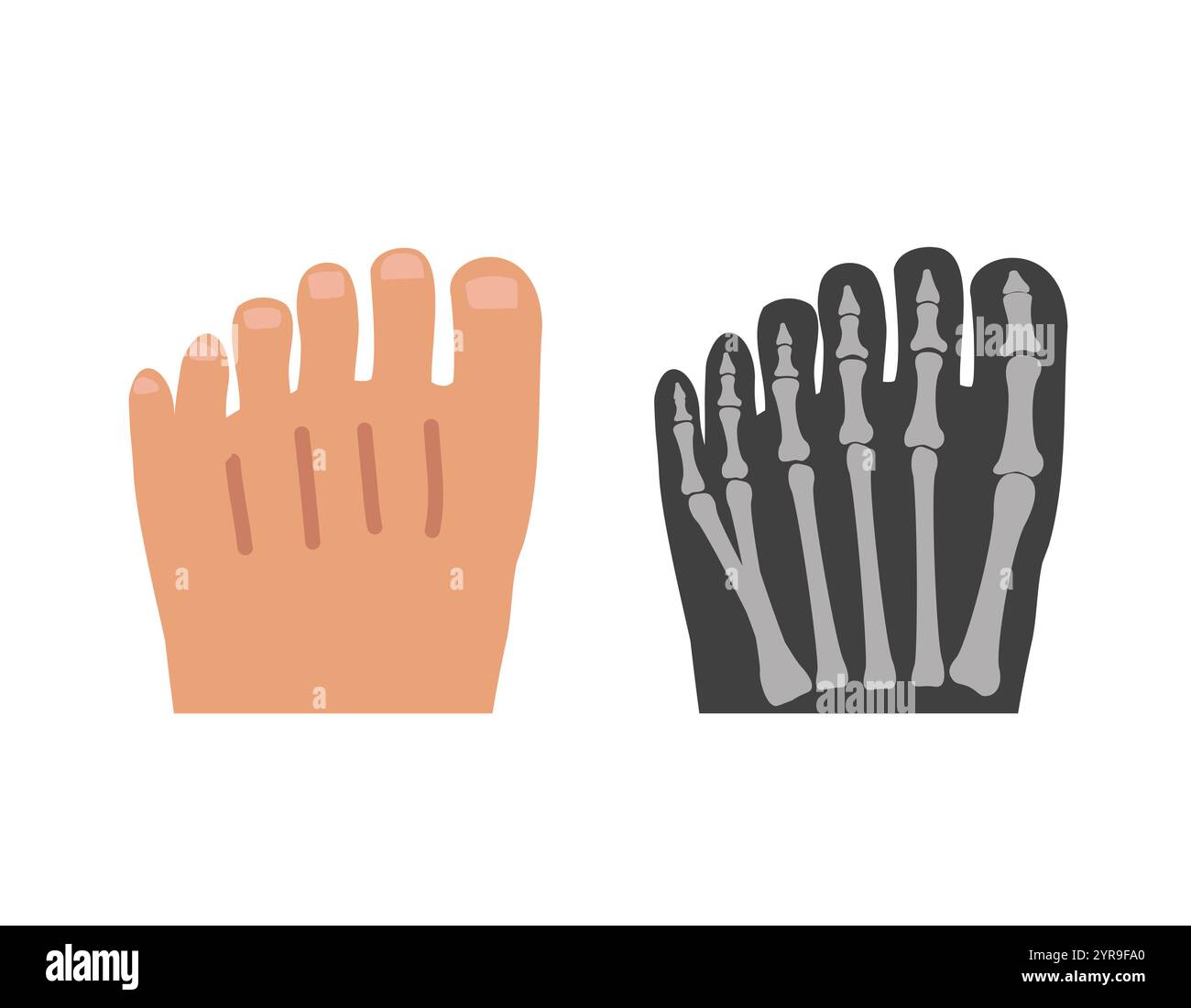 Human polydactyly. 6 toe external and internal view on x-ray. Medical ...