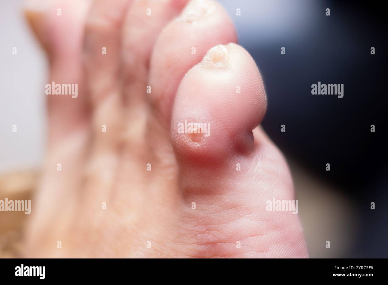 This image shows a closeup view of a persons foot, specifically ...