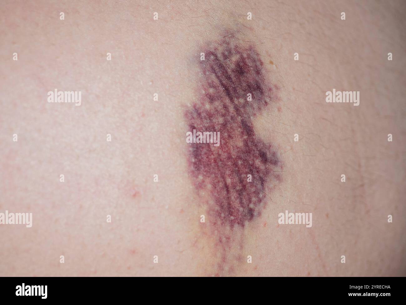 Skin abrasion hi-res stock photography and images - Alamy