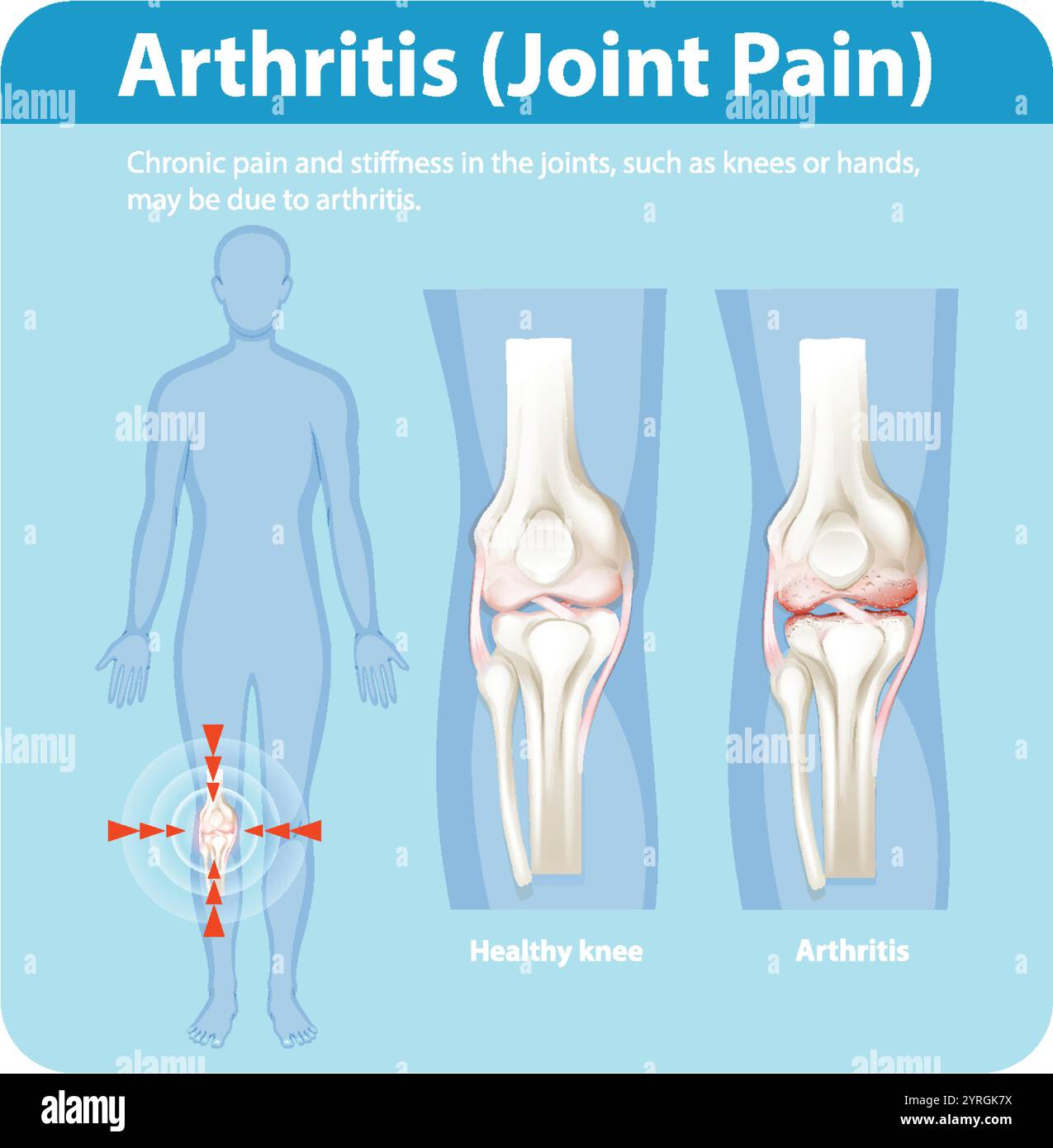 Illustration of healthy and arthritic knee joints Stock Vector Image ...