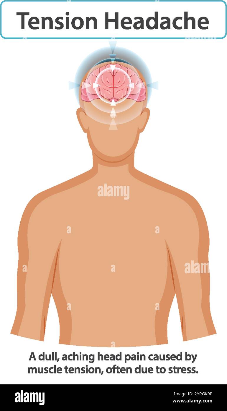 Illustration of tension headache symptoms and causes Stock Vector Image ...