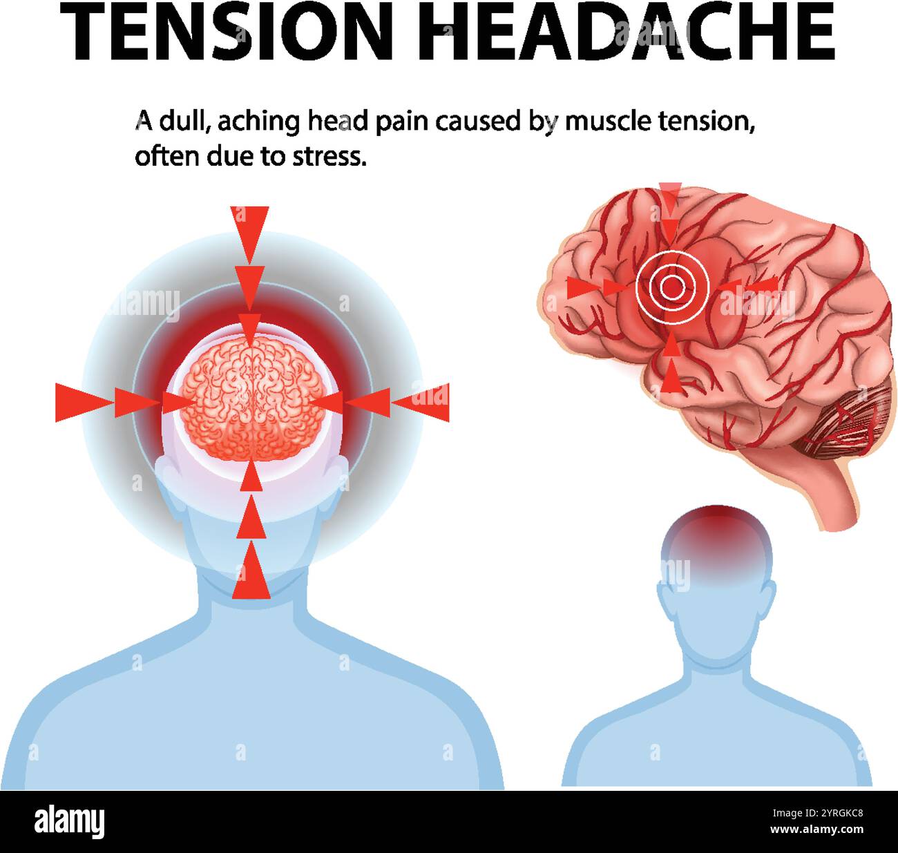 Illustration of tension headache symptoms and brain anatomy Stock ...