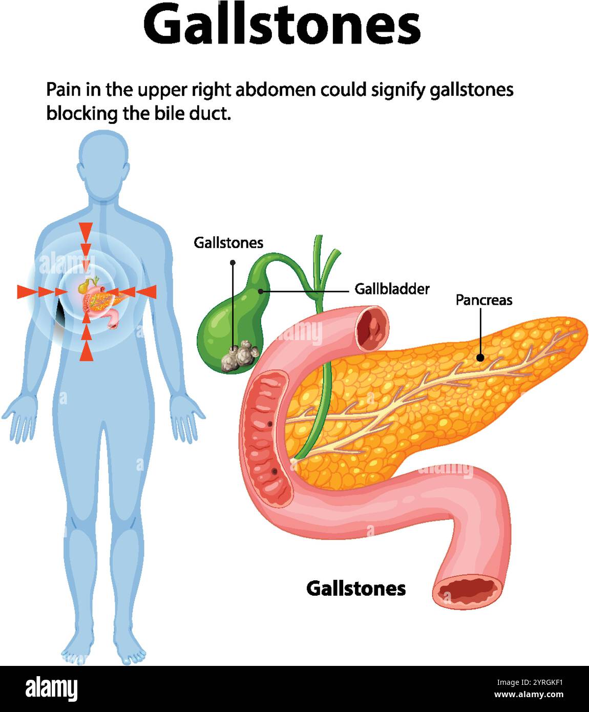 Illustration of gallstones affecting the bile duct Stock Vector Image ...