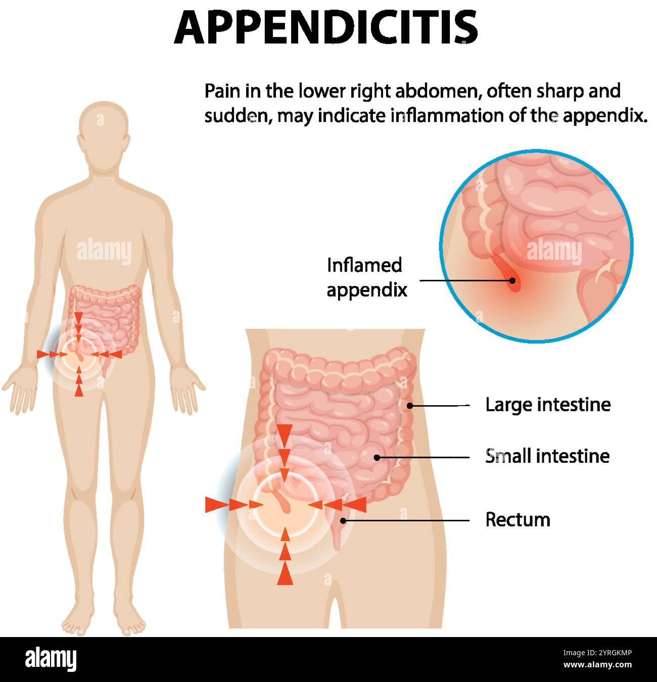 Illustration of appendicitis symptoms and affected organs Stock Vector Image & Art - Alamy