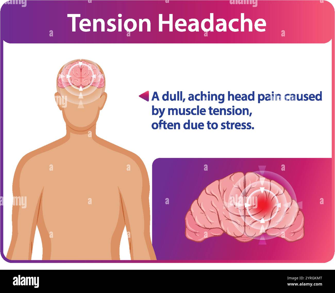 Illustration of tension headache symptoms and causes Stock Vector Image ...